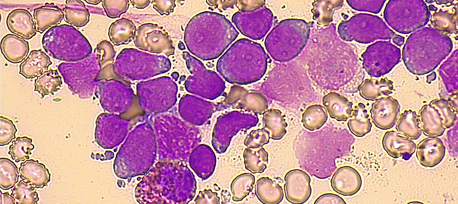 CCBIO Mini Symposium – Development of novel therapy for acute myeloid ...