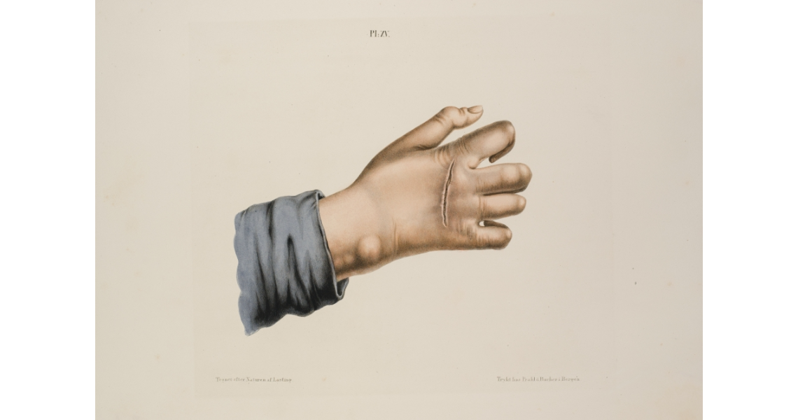 Lepra undervisningspakke | Universitetet i Bergen