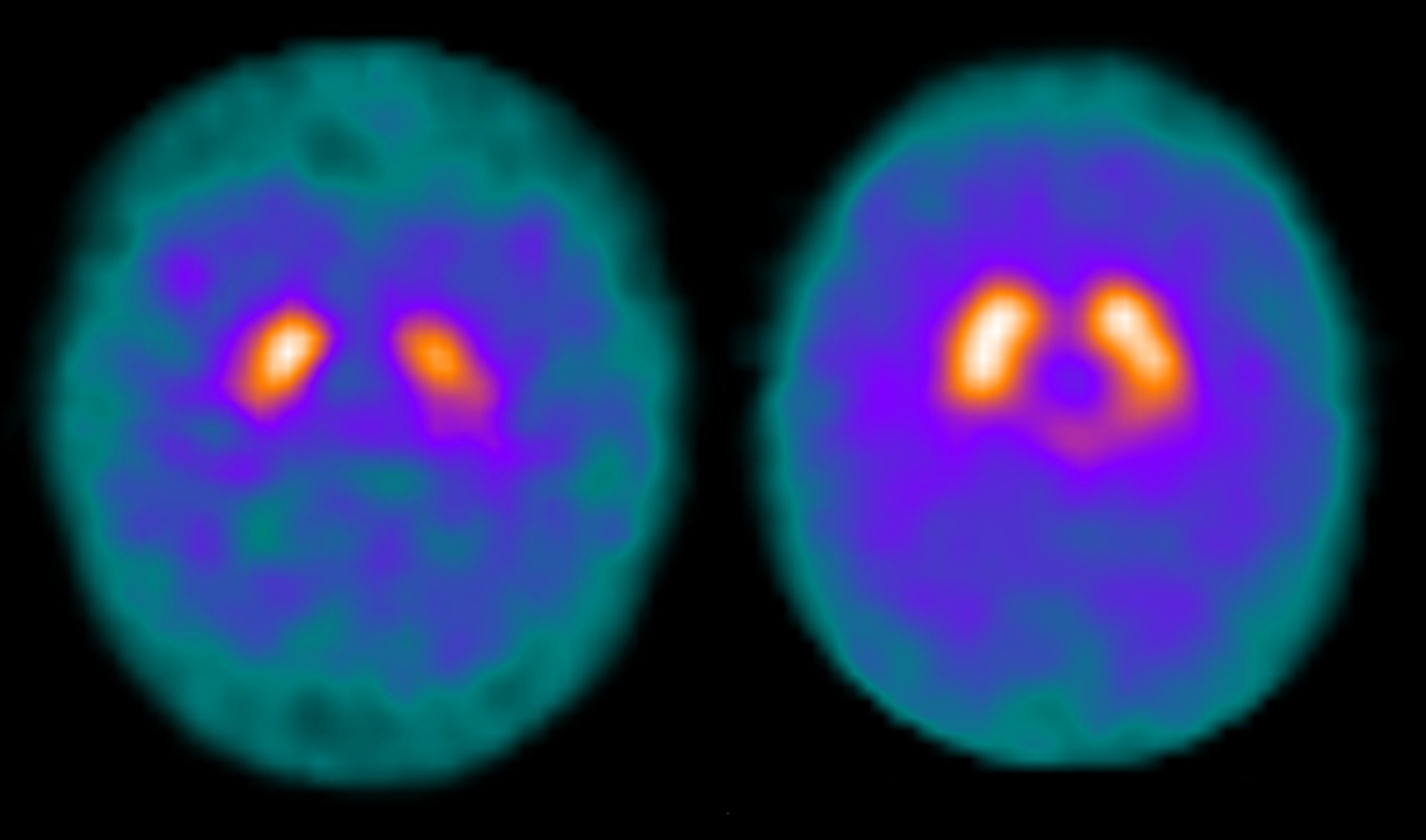Neuromics.org: Translational Science in Neurodegeneration and Aging | University of Bergen