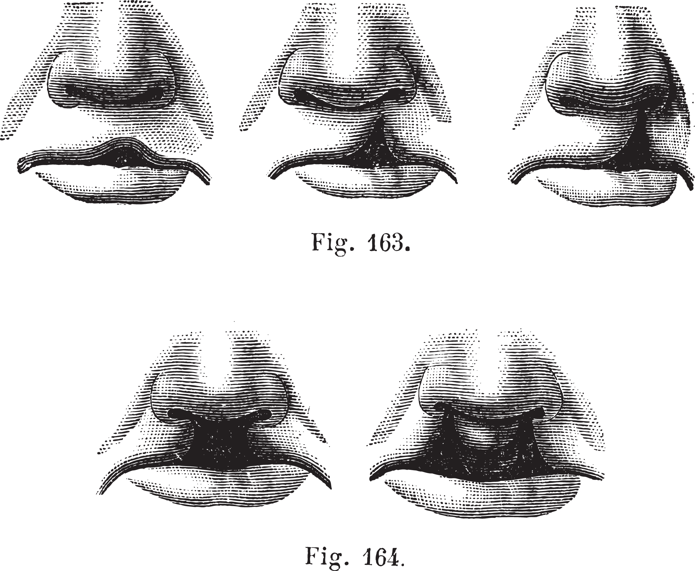 Parental age and risk of cleft lip | Section for epidemiology and ...