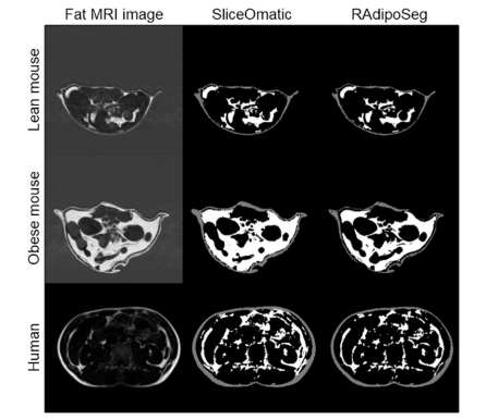 MRI adipose tissue segmentation and quantification in R (RAdipoSeg ...