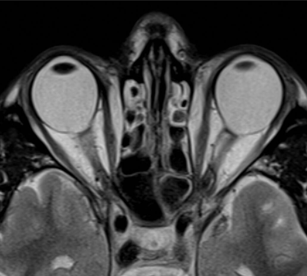 Bergen Ophthalmogenetic Research Group | Department of Clinical ...