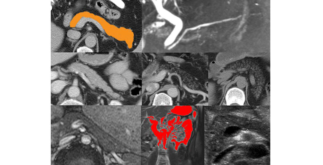 Pancreatic imaging | Bergen Cancer Imaging Research Group (BCIRG) | UiB