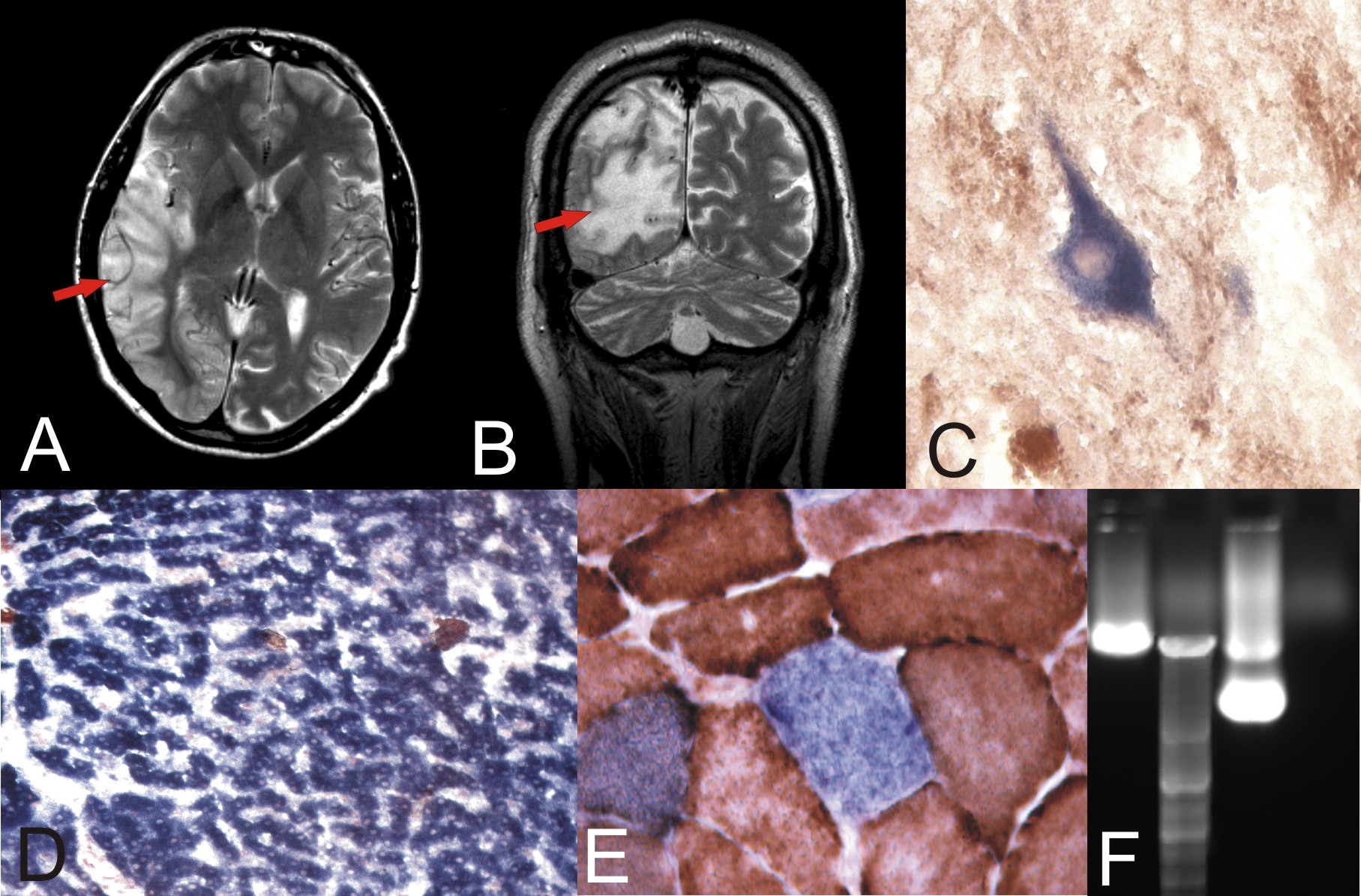 Mitochondria & Disease | Mitochondrial Medicine & Neurogenetics (MMN) | UiB